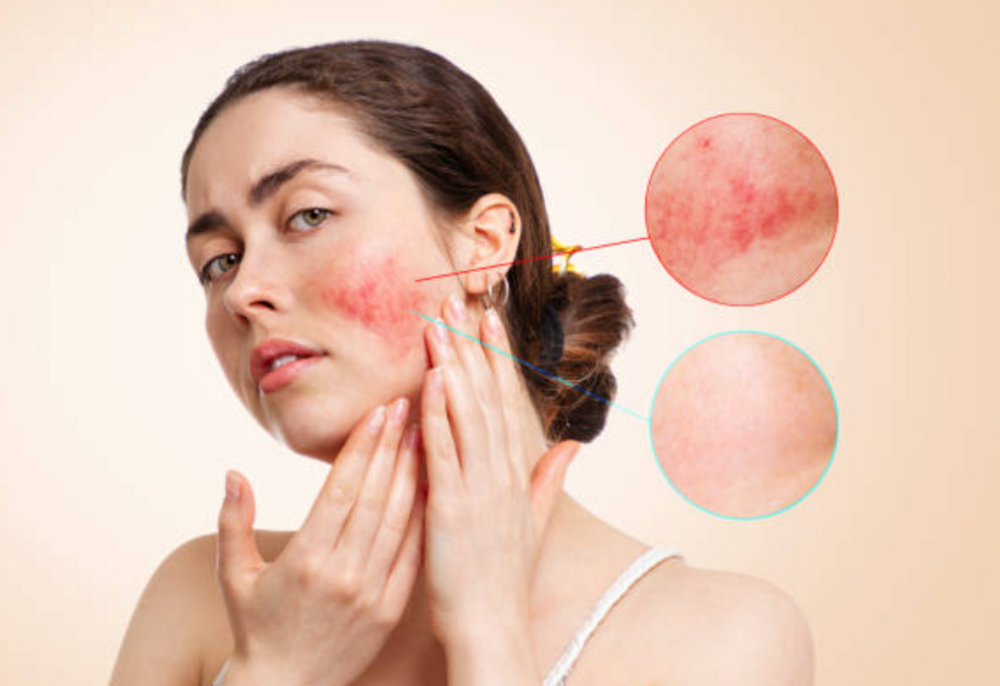Get Rid of Face Redness: Your Ultimate Guide To 5 Causes and Effective ...